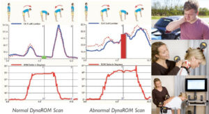 Patients | MyoVision